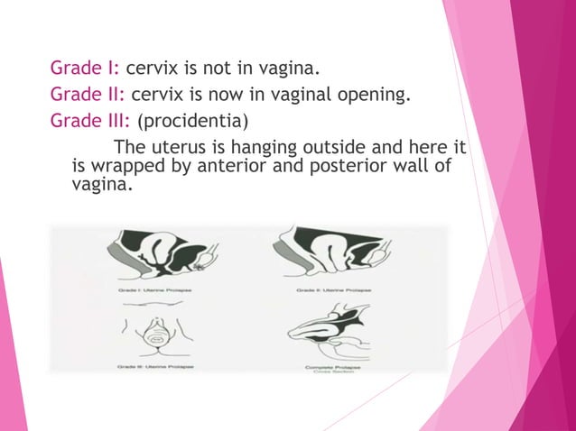 Uterovaginal prolapse By Dr rizwan ullah khan | PPT