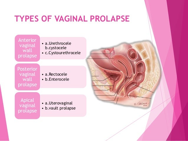 Uterovaginal prolapse By Dr rizwan ullah khan