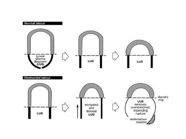 Uterus rupture and uterus cervix rupture | PPTX | Pregnancy ...