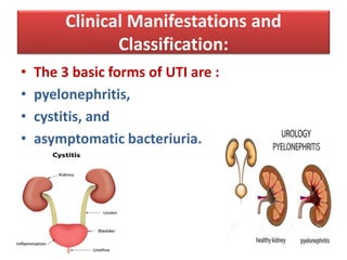 Urinary Tract Infections in children | PPTX