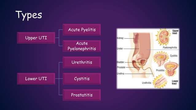 Urinary Tract Infection (UTI) | PPT
