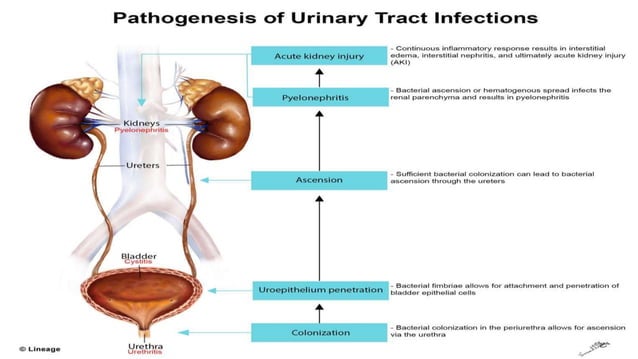 Urinary tract infection (UTI) | PPT