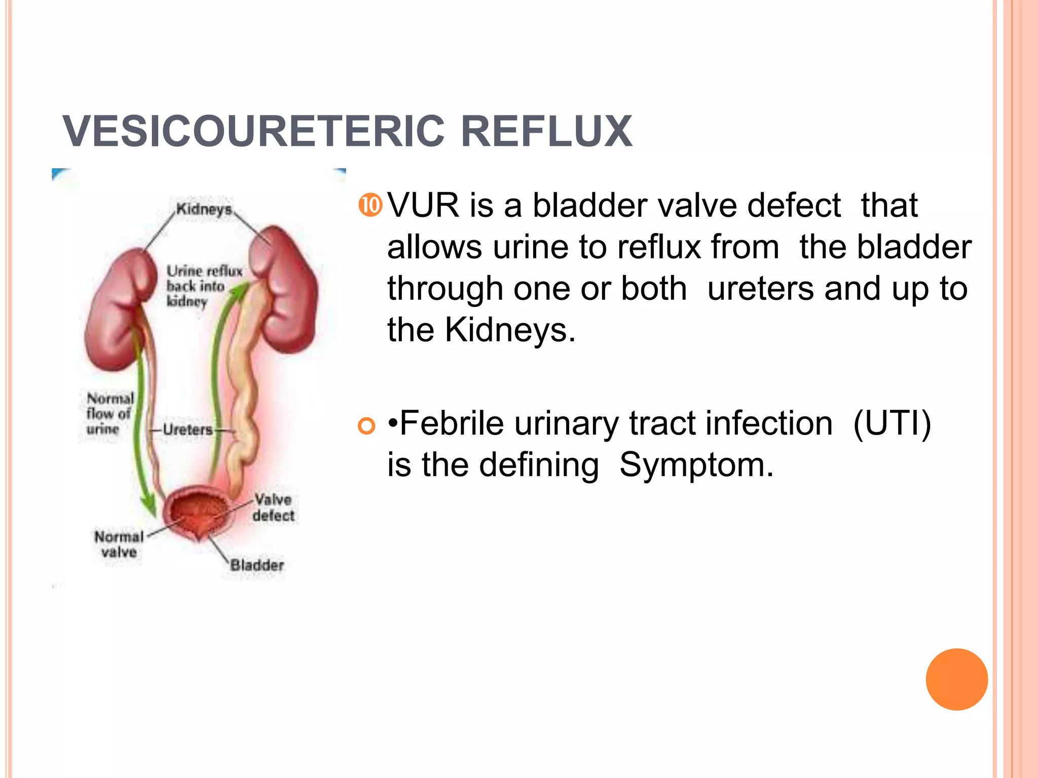 URINARY TRACT INFECTION IN CHILDREN | PPTX