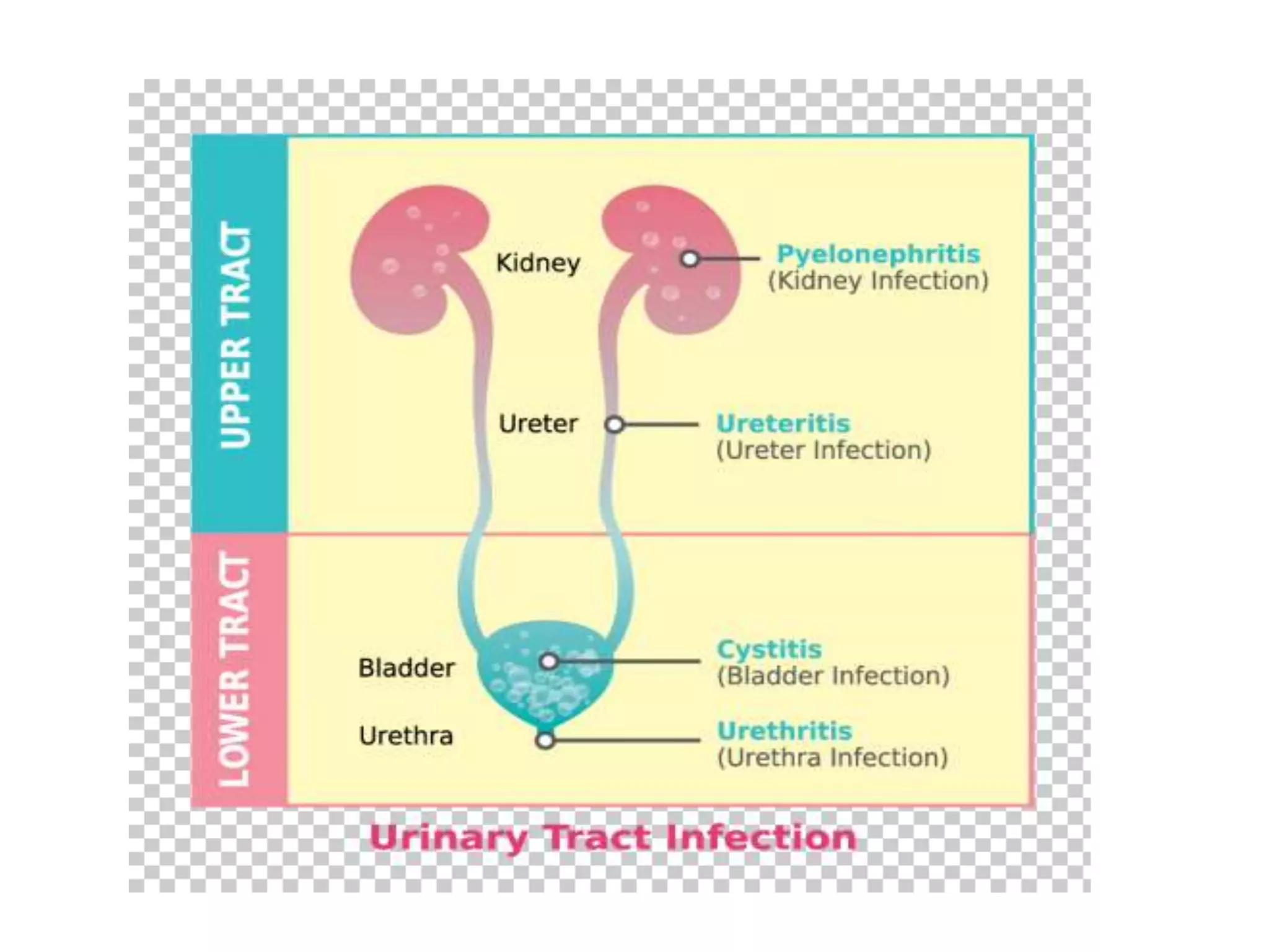 Urinary Tract Infection | PPTX