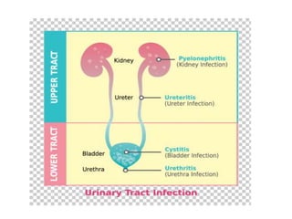 Urinary Tract Infection | PPTX