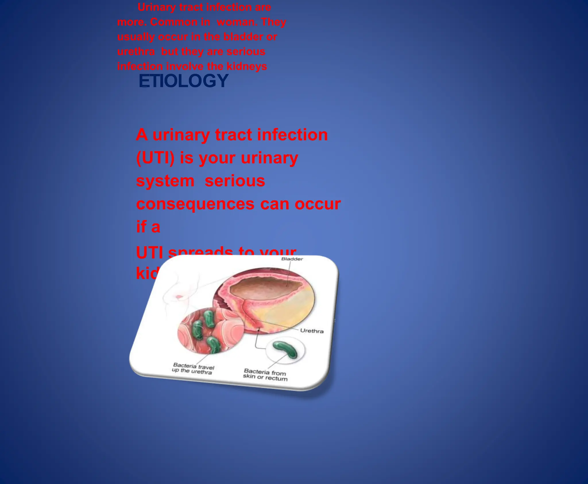 PowerPoint on Urinary Tract Infections(UTI) | PPTX