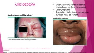 UTICARIA Y ANGIOEDEMA: diagnostico, clínica, tratamiento | PPTX