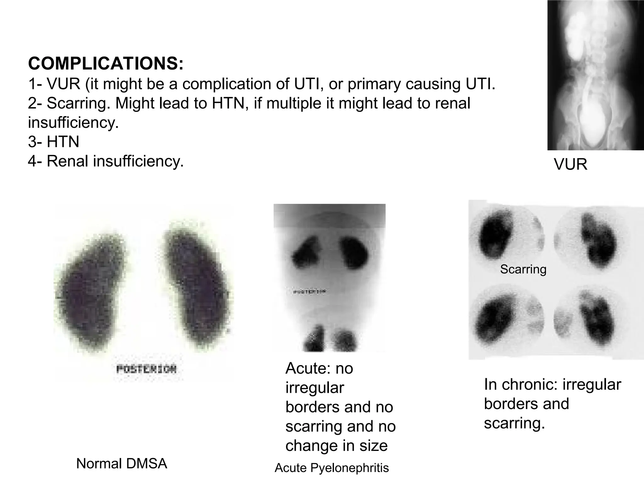 UTI in Children infeccion urinaria en pediatria | PPT