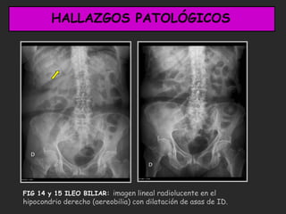 Utilidad de la_radiografia_de_abdomen_en_la_urgencia | PDF