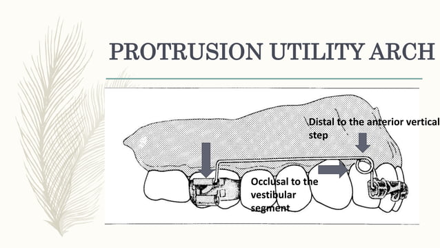 Utility arch | PPTX | Dental Health | Diseases and Conditions