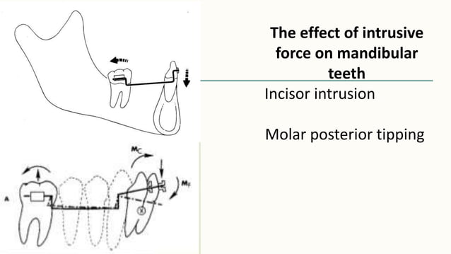 Utility arch | PPTX | Dental Health | Diseases and Conditions