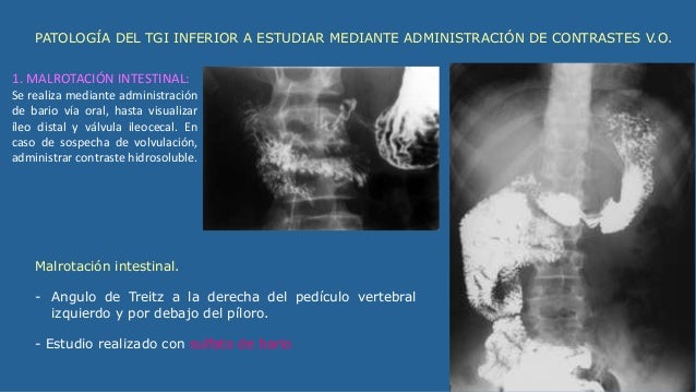 Utilización de contrastes vía enteral