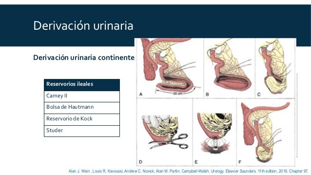 Utilización de segmentos intestinales en la derivación urinaria