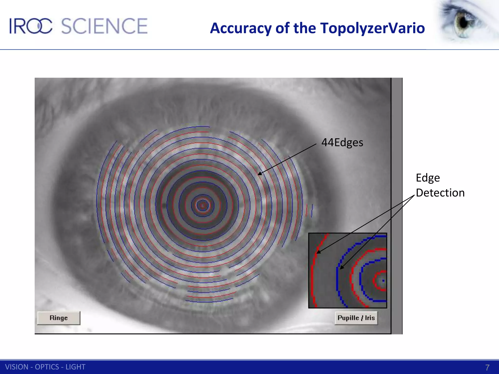 Utilizing topolyzer vario & oculyzer ii for accurate refractive | PPTX