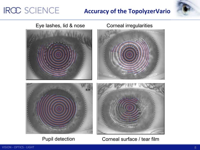 Utilizing topolyzer vario & oculyzer ii for accurate refractive | PPT