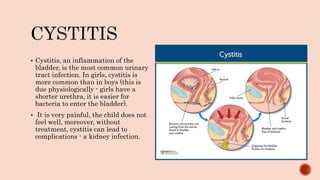 URINARY TRACT INFECTION IN CHILDREN | PPTX