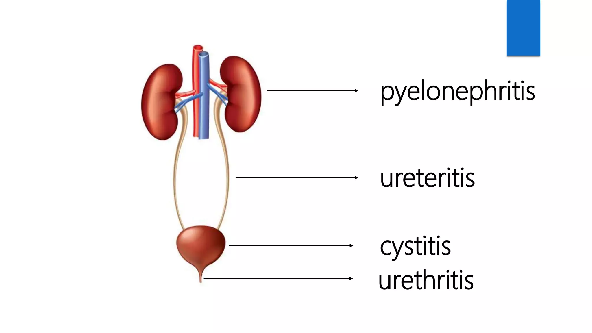 Urinary track infection | PPTX