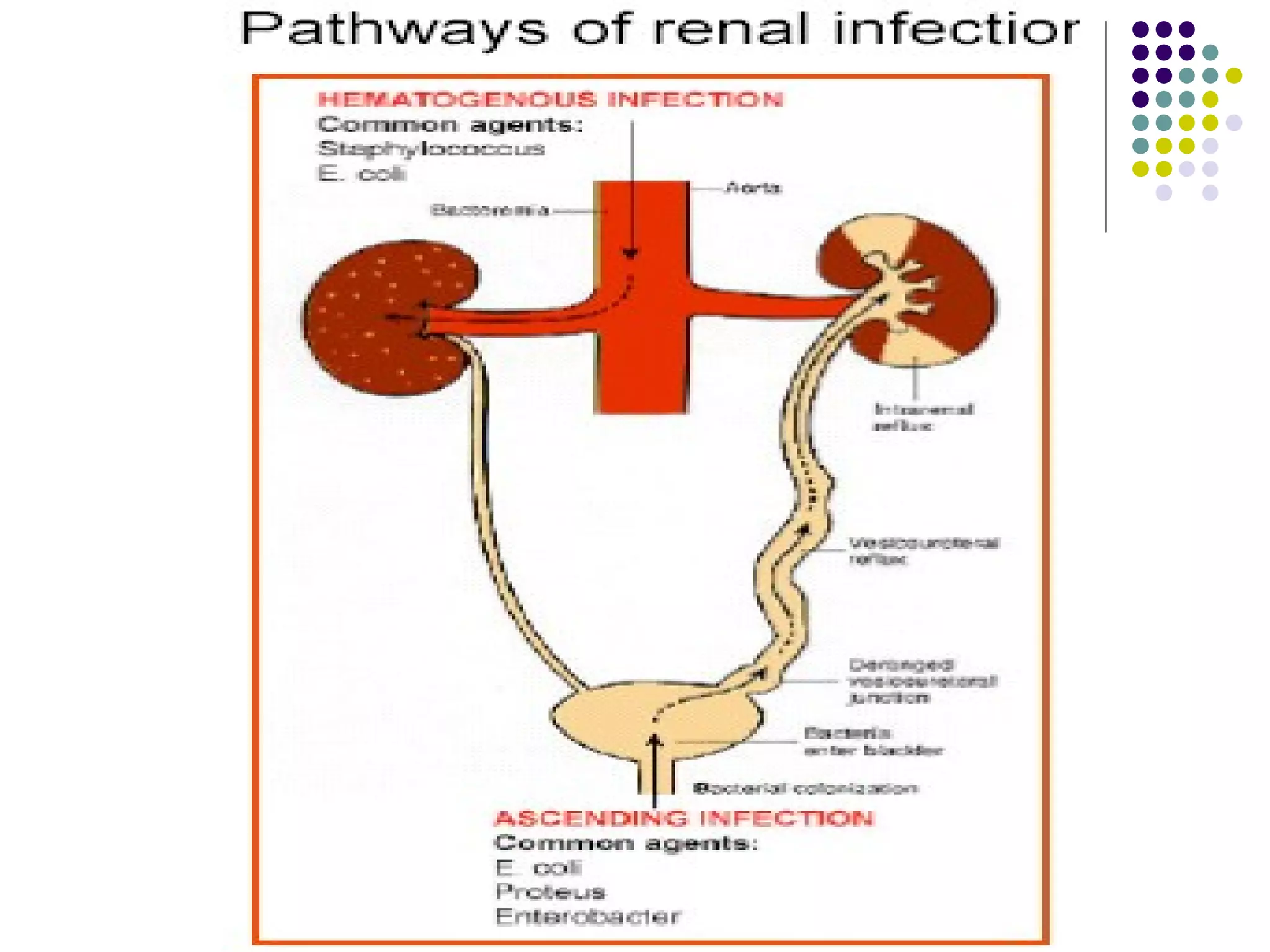 Urinary Tract Infection (UTI) | PPT