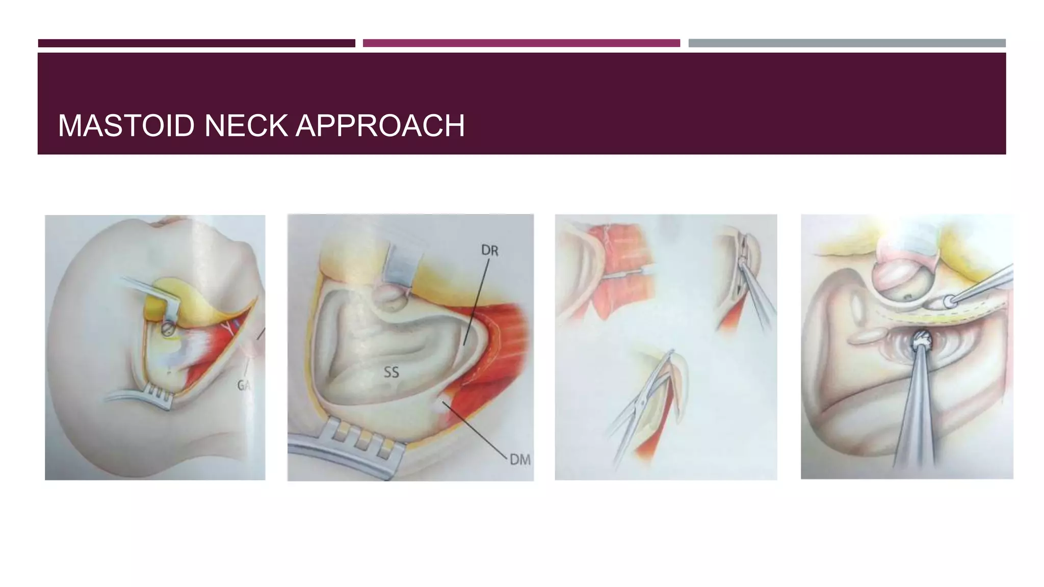 Glomus Tumour | PPSX