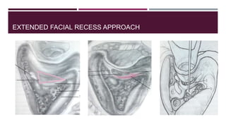 Facial Recess Approach