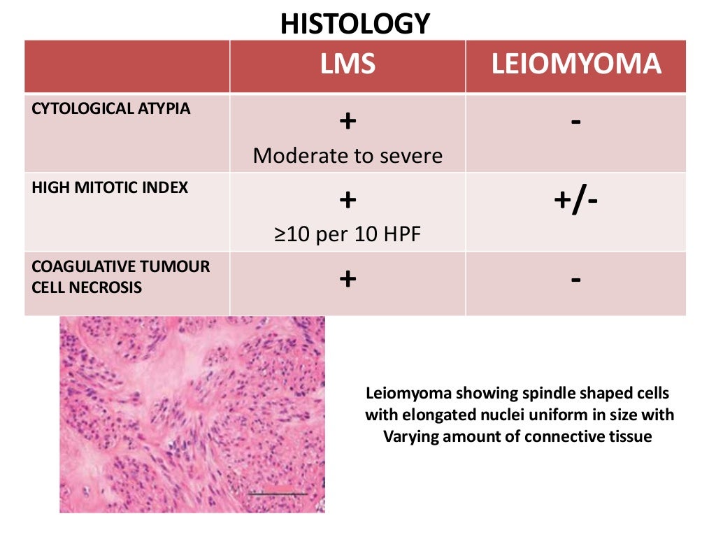 UTERINE LEIOMYOSARCOMA