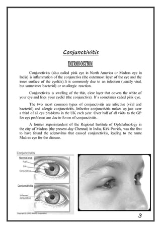 A Project on CONJUNCTIVITIS and HYPERTHYROIDISM | DOCX