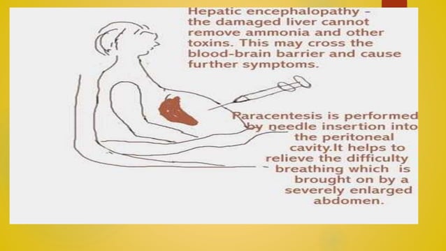 ABDOMINAL PARACENTESIS | PPTX | First Aid | Injuries