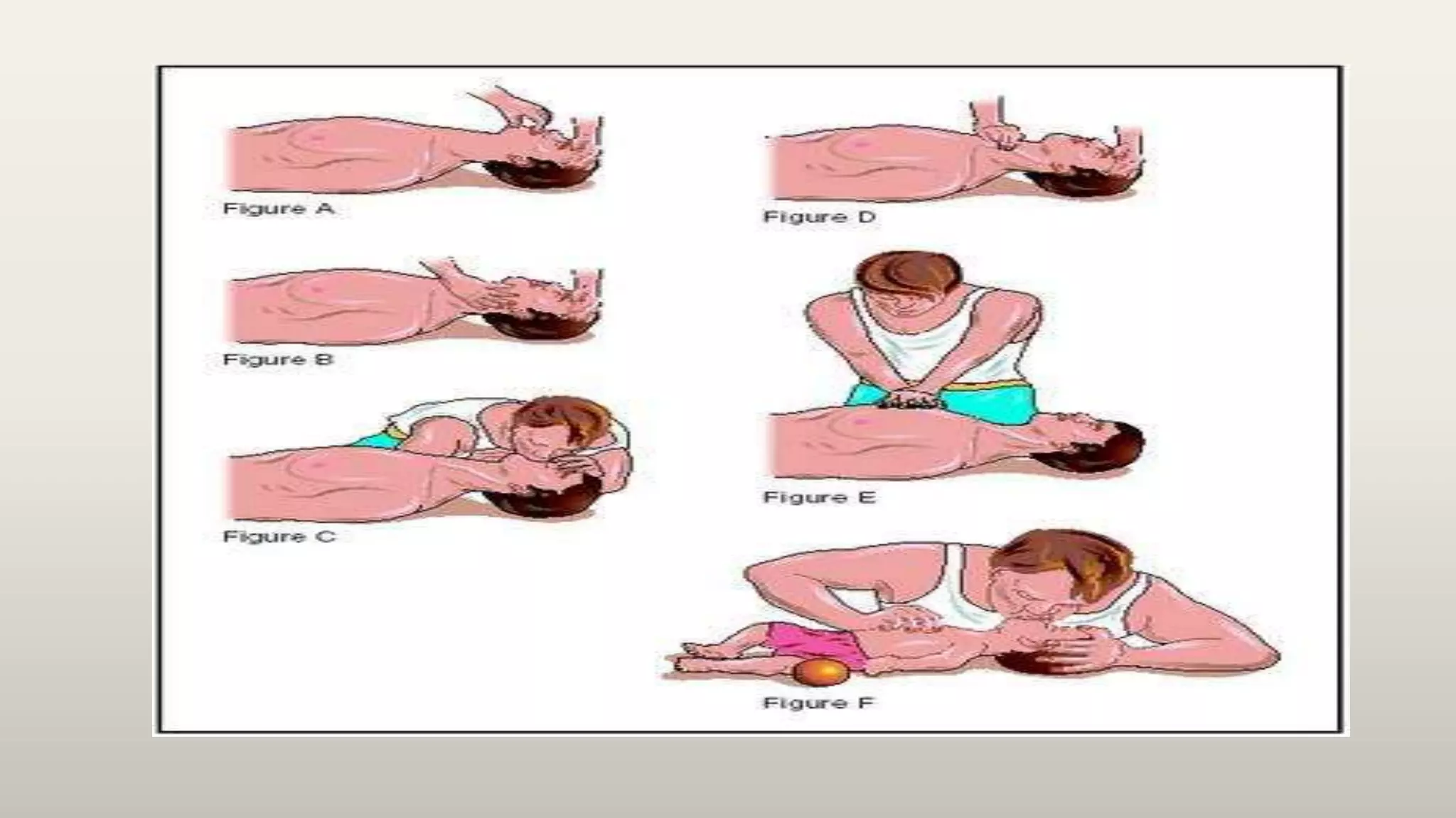 Cardio Pulmonary Resuscitation | PPTX