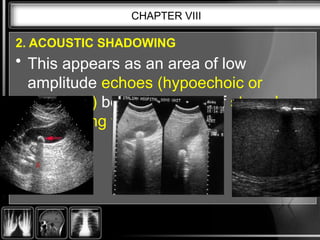 Ultrasound Artifacts_powerpoint presentation | PPTX