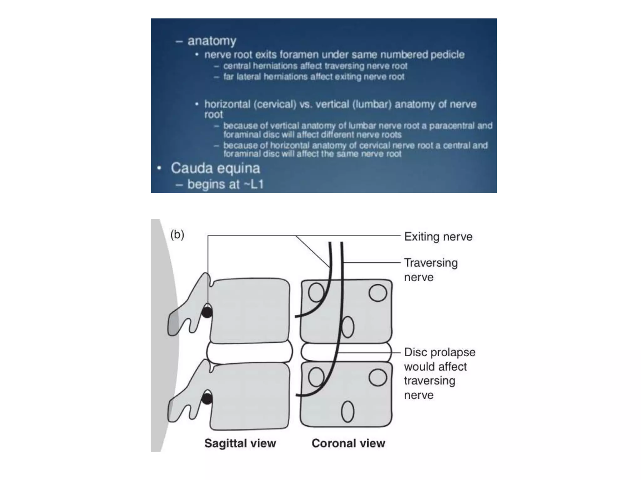 Lumbar intervertebral disc anatomy, biomechanics and pathogenesis of ...
