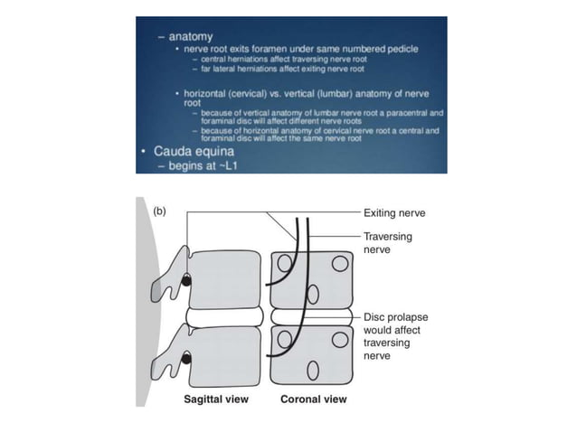 Lumbar intervertebral disc anatomy, biomechanics and pathogenesis of ...