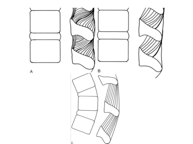 Lumbar intervertebral disc anatomy, biomechanics and pathogenesis of ...