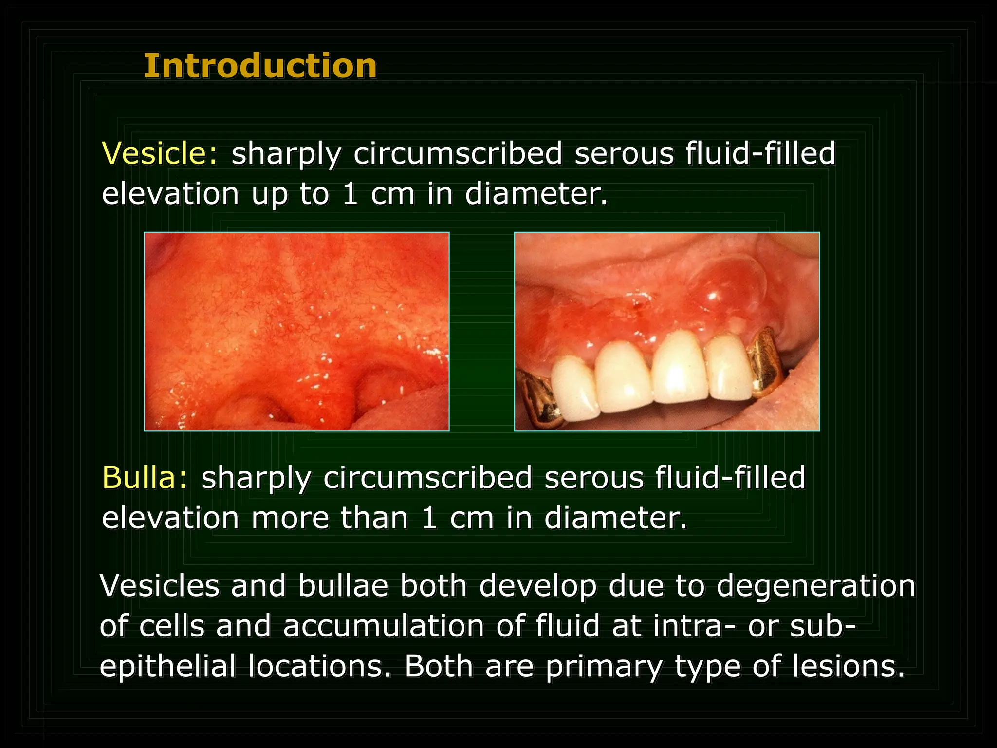 VB Lesions/Mucocutaneous lesions of oral cavity.ppt