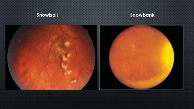 PATOLOGÍAS DE LA UVEA