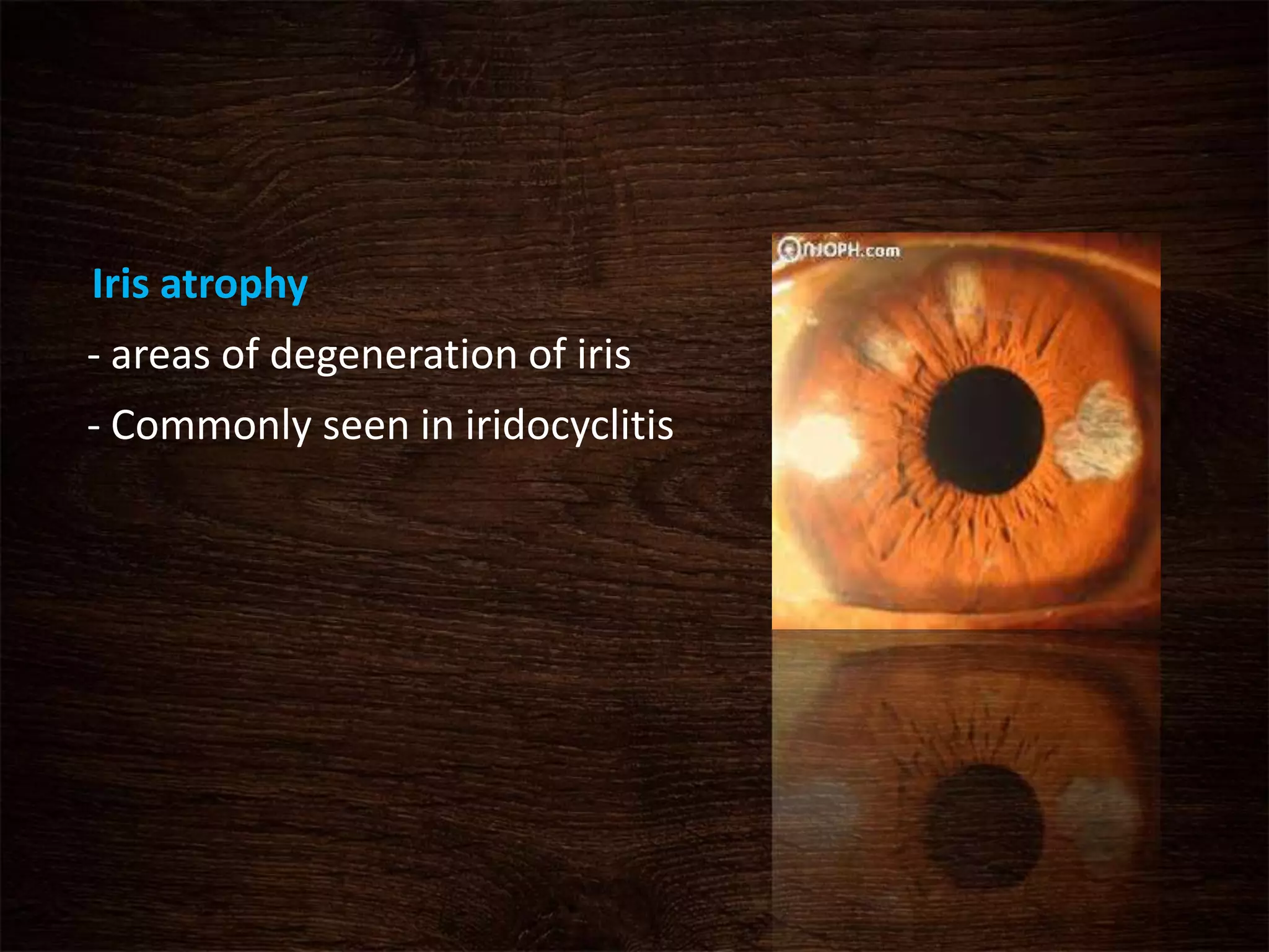 Uvea anatomy | PPTX