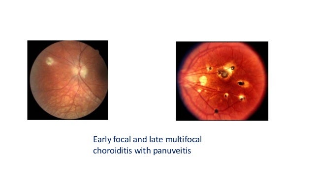 Uveitis