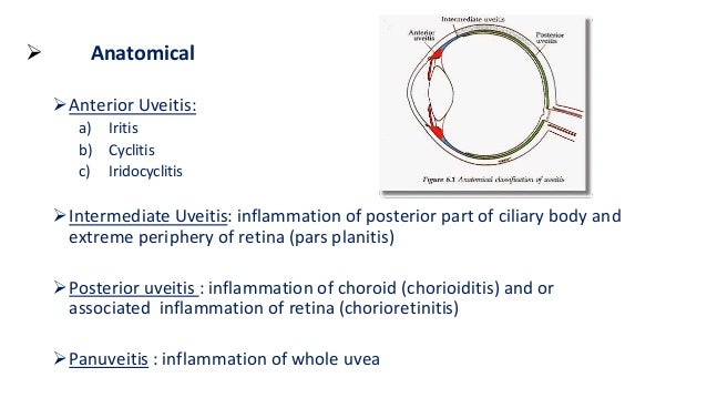 Uveitis