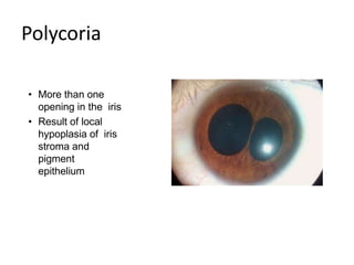 Anatomy and Applied aspects of Uvea | PPTX