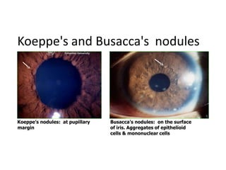 Busacca Nodules
