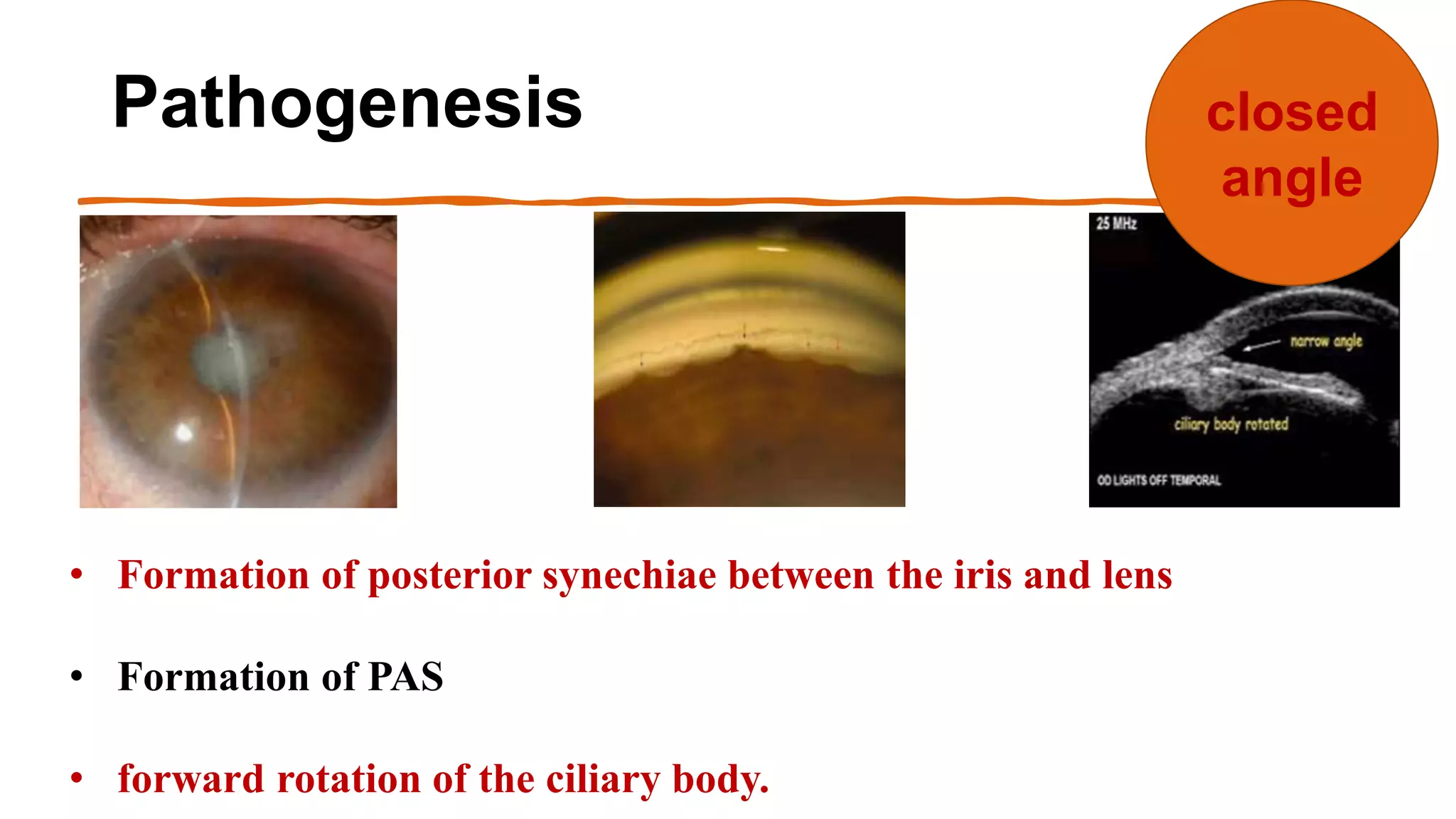 Uveitic glaucoma.pptx