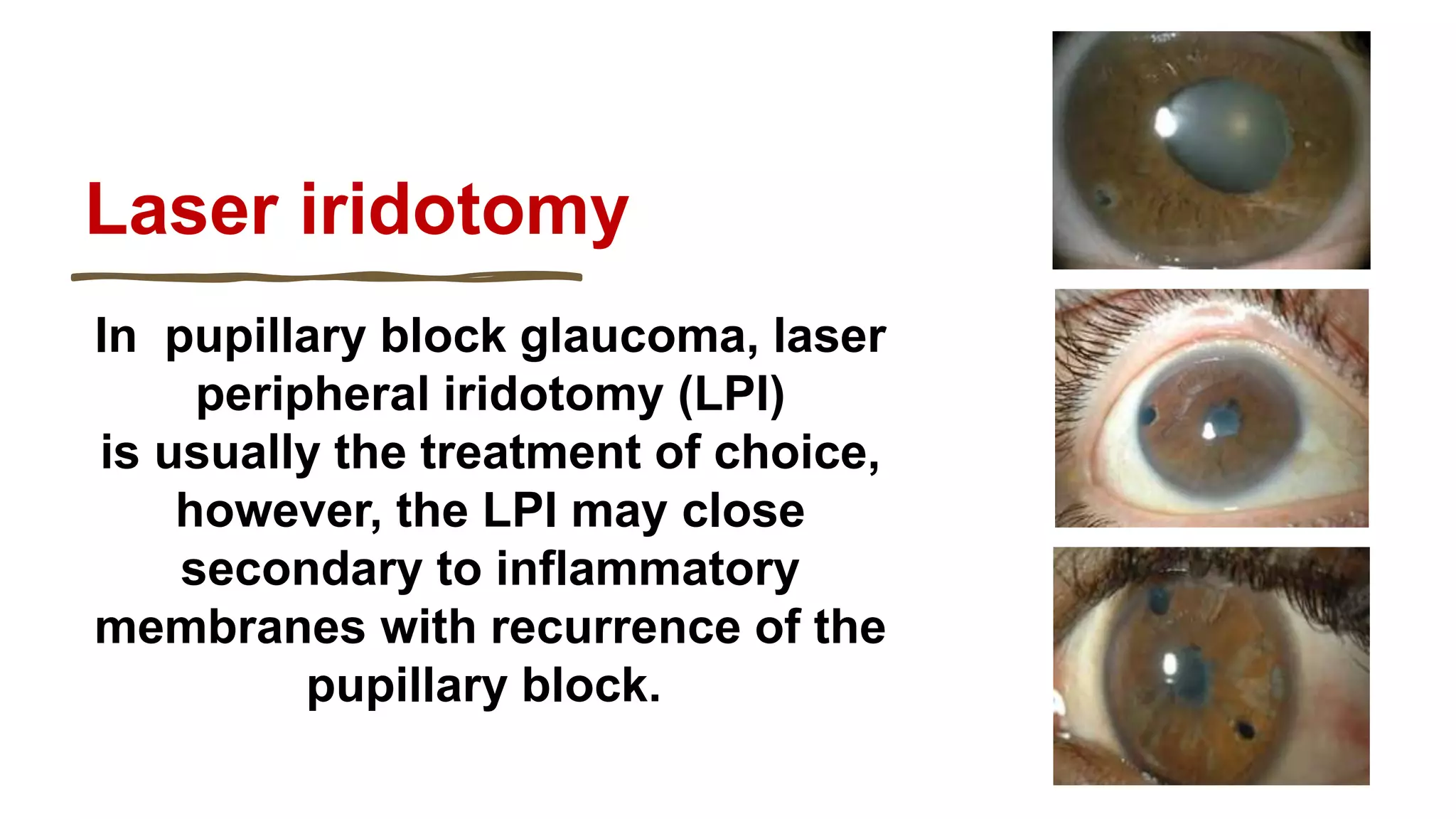 Uveitic glaucoma.pptx