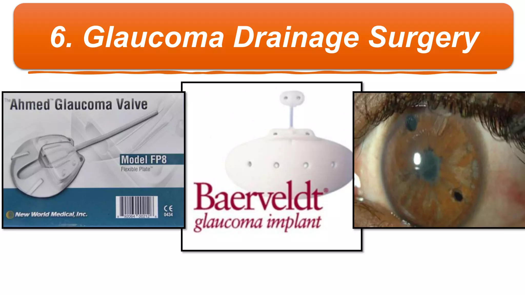 Uveitic glaucoma.pptx