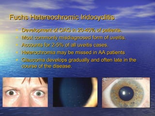 Uveitic Glaucoma | PPT