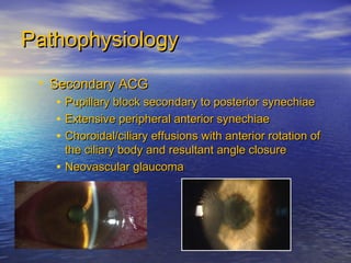 Uveitic Glaucoma