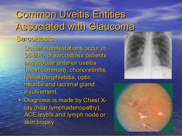 Uveitic Glaucoma