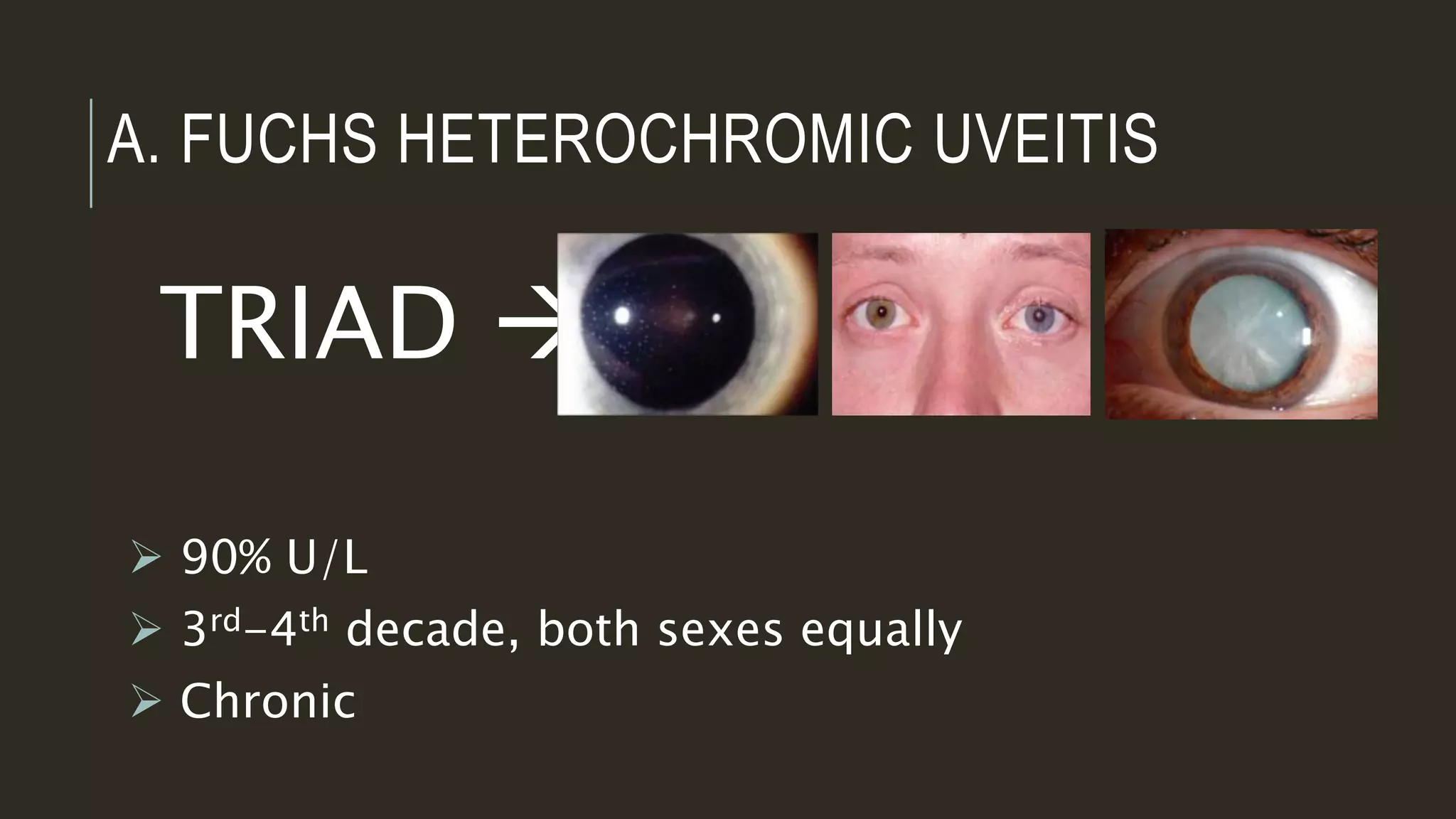 Uveitic glaucoma | PPTX