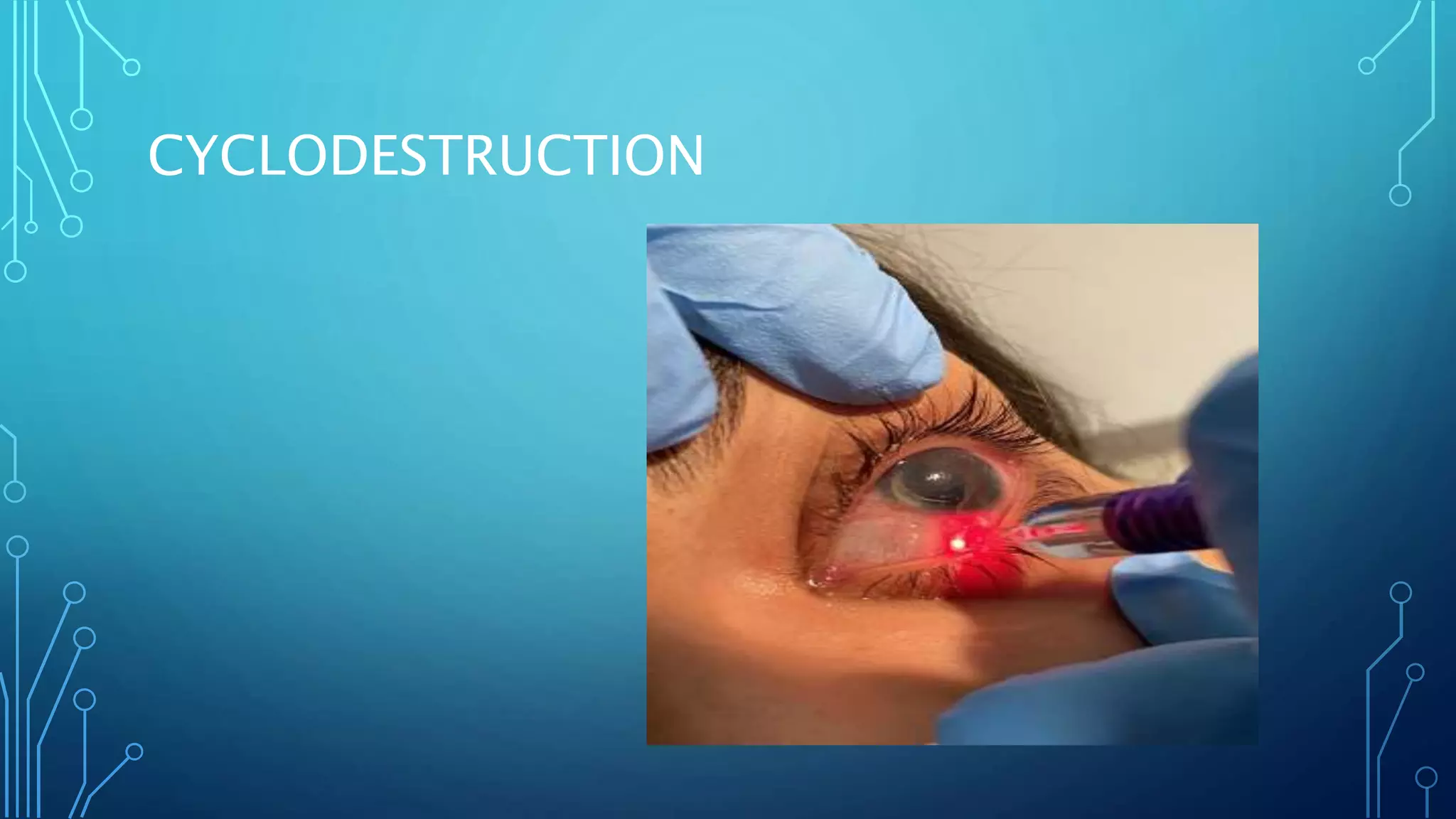 uveitic inflammatory glaucoma.pptx
