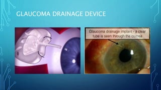 uveitic inflammatory glaucoma.pptx