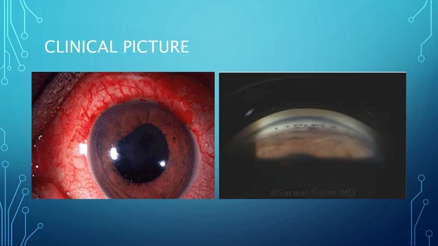 uveitic inflammatory glaucoma.pptx