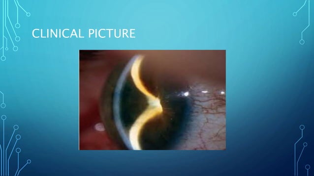 uveitic inflammatory glaucoma.pptx